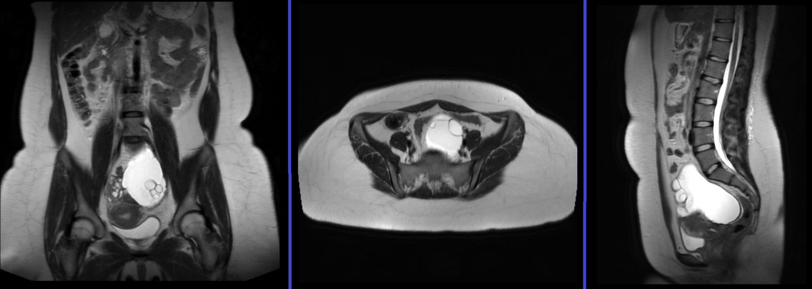 Mri Ovarian Ca Mri Ovarian Cancercyst Protocol And Planning
