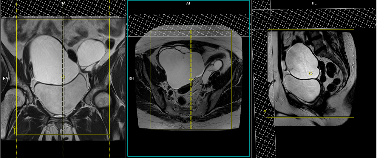 MRI Ovarian CA | MRI Ovarian Cancer/Cyst Protocol and Planning