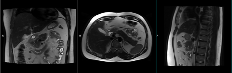 Pancreas MRI Respiratory Gated Protocol and Planning | MRI MRCP Pancreas
