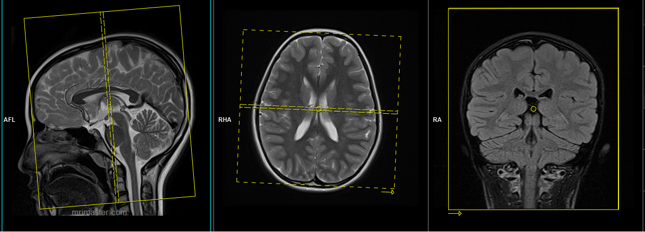 Pediatric Brain MRI Planning | MRI Pediatric Brain Protocols ...