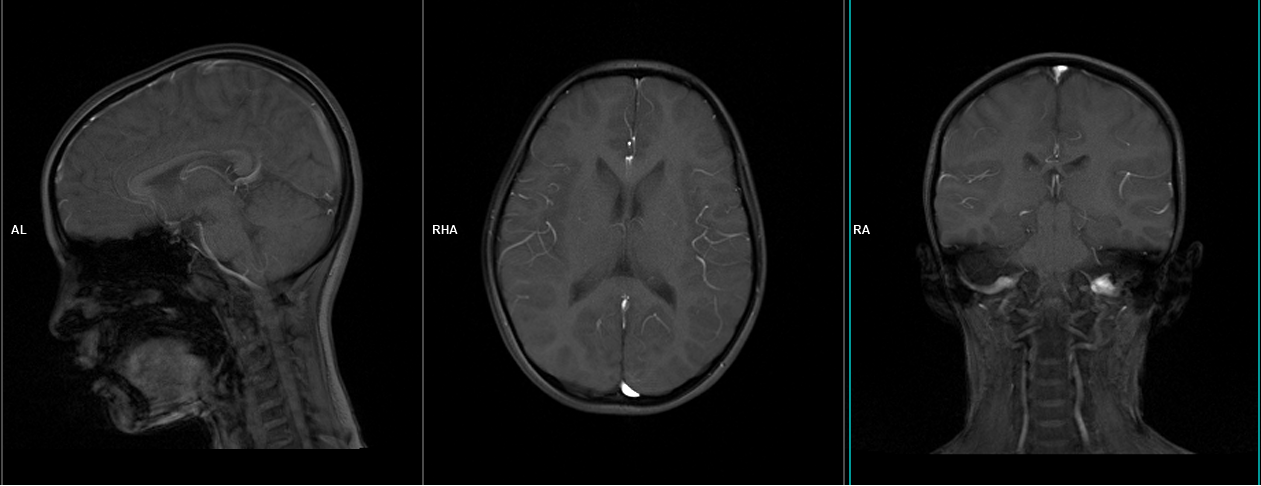 Pediatric Brain MRI Planning | MRI Pediatric Brain Protocols ...