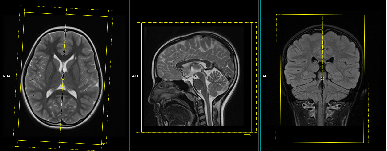 Pediatric Brain MRI Planning | MRI Pediatric Brain Protocols ...