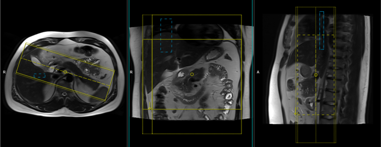 Secretin Stimulated MRCP Planning and Protocols| Indications for ...