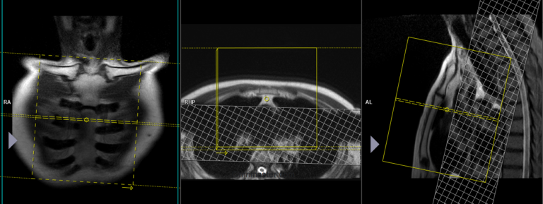MRI Sternum or Sternoclavicular Joint Planning and Protocols and ...