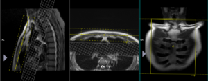 MRI Sternum or Sternoclavicular Joint Planning and Protocols and ...