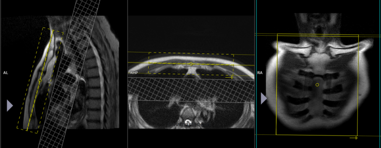 MRI Sternum or Sternoclavicular Joint Planning and Protocols and ...