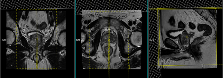 MRI prostate planning | Dynamic MRI prostate protocols