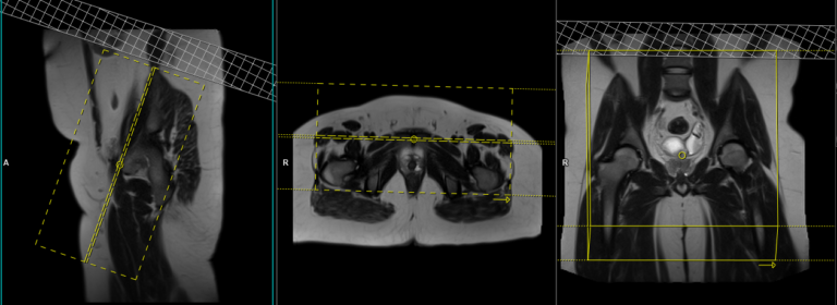 MRI Sports Hernia Scan | Sports Hernia MRI Protocol and Planning