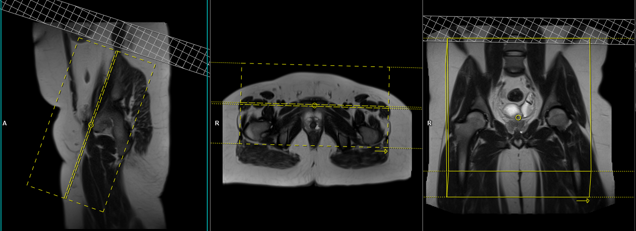 MRI Sports Hernia Scan | Sports Hernia MRI Protocol and Planning