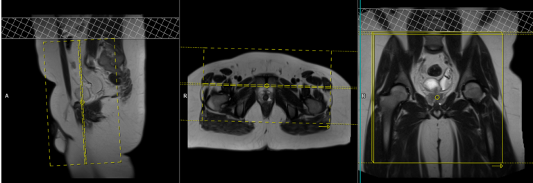 MRI Sports Hernia Scan | Sports Hernia MRI Protocol and Planning