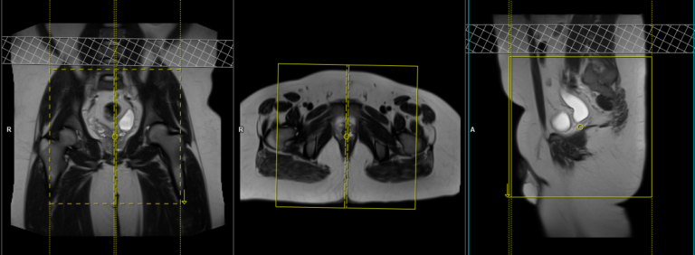 MRI Sports Hernia Scan | Sports Hernia MRI Protocol and Planning
