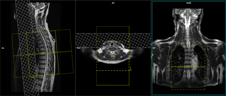 Thoracic spine MRI Planning and Protocols | Indications for MRI ...