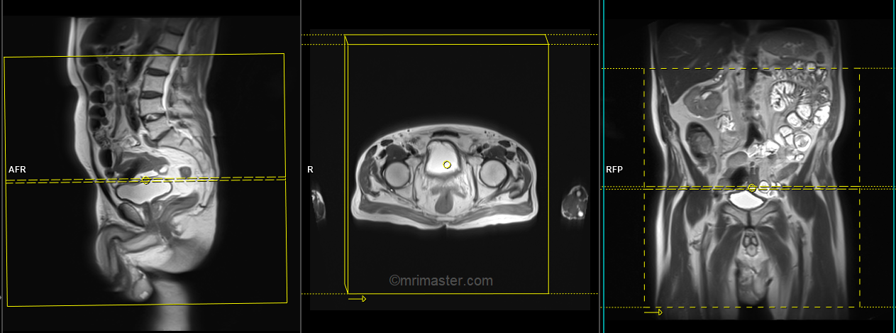 Testicular MRI Planning | Testis MRI Protocols and Indications