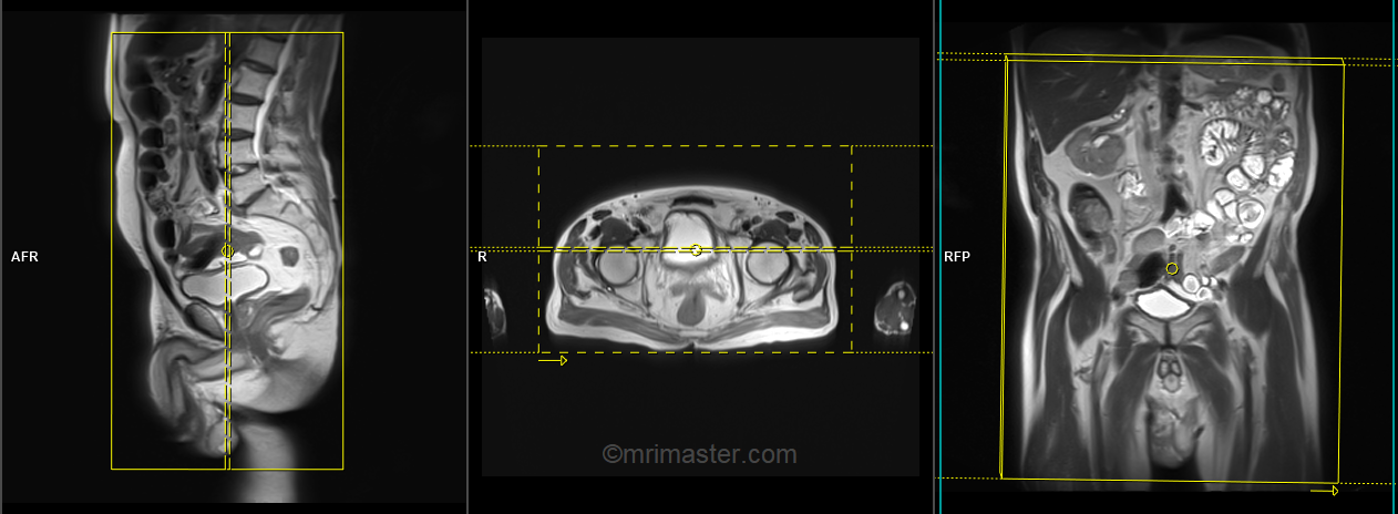 Testicular MRI Planning | Testis MRI Protocols and Indications