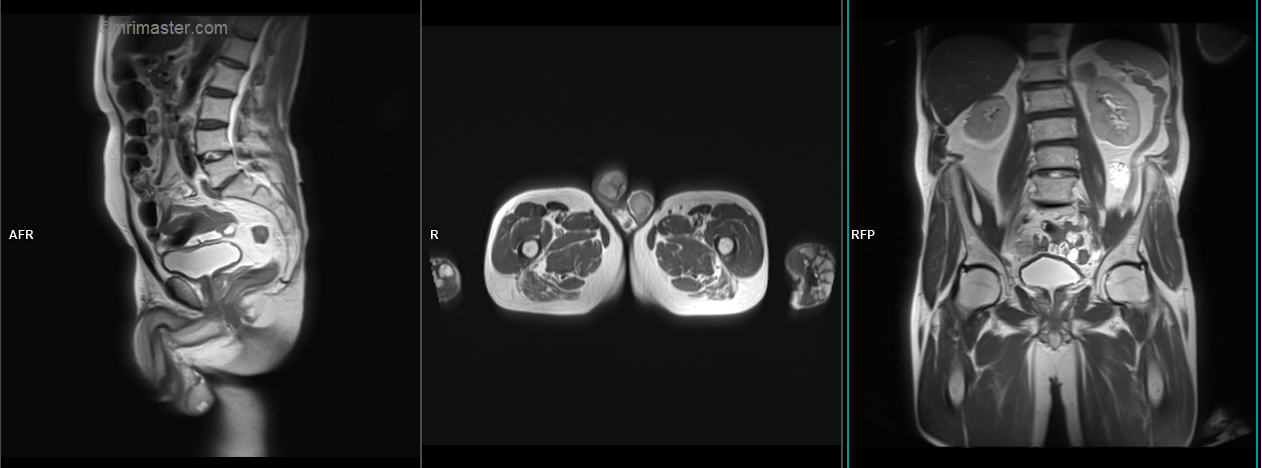 Testicular MRI Planning | Testis MRI Protocols and Indications