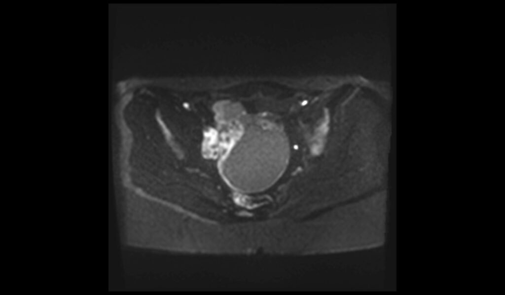 ovarian cancer protocol axial DWI images
