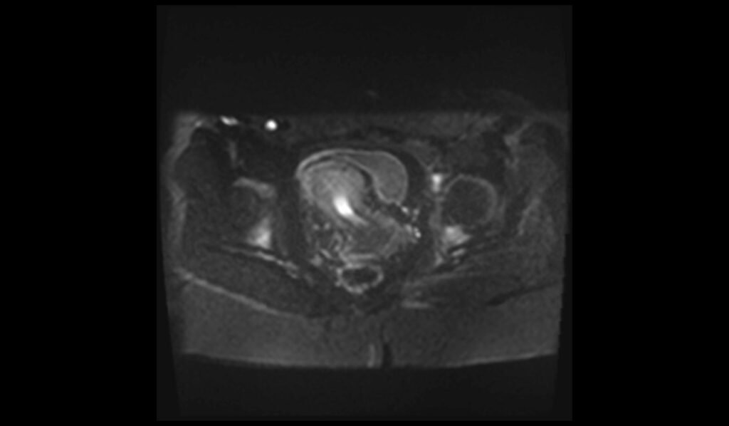 ovarian cancer protocol axial DWI images