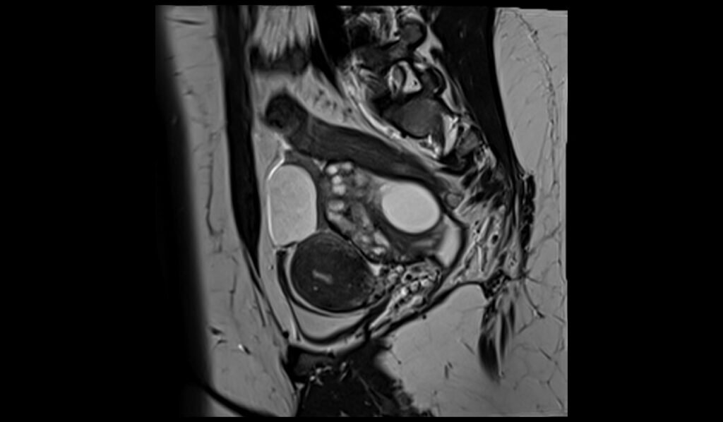 Ovarian Cancer Protocol Sagittal T2 Images Mrimaster