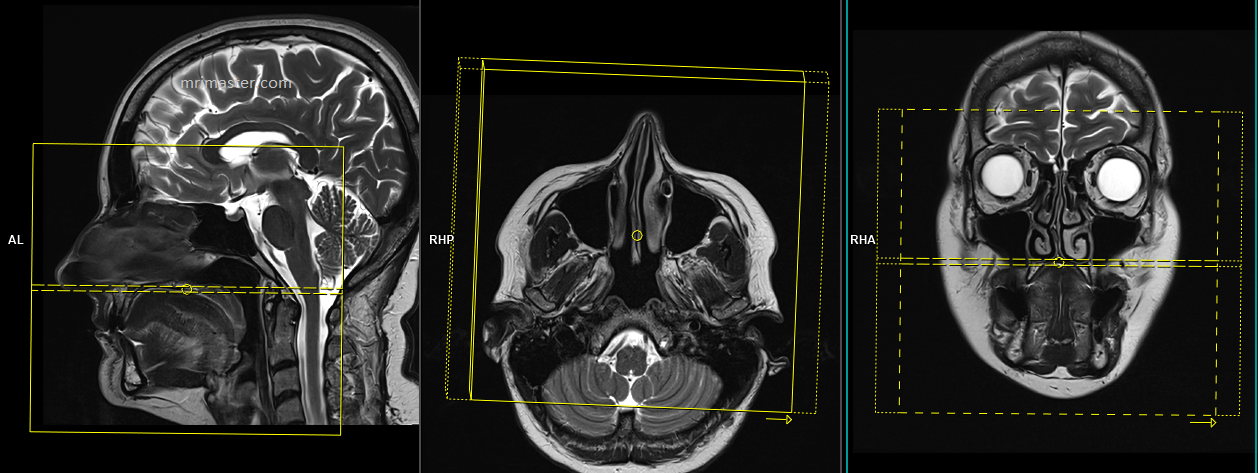 MRI Face (Oral Cavity) Protocols and Planning | Indications for MRI ...