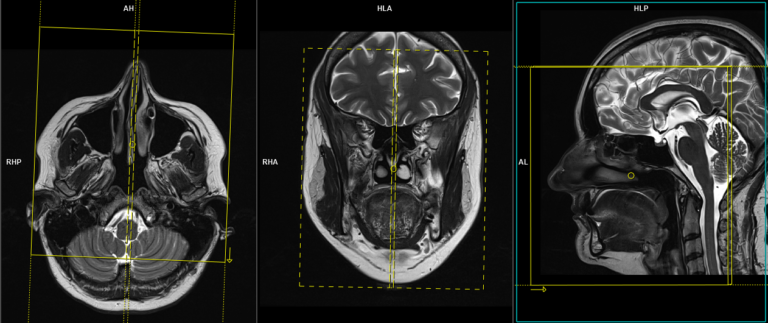MRI Face (Oral Cavity) Protocols and Planning | Indications for MRI ...