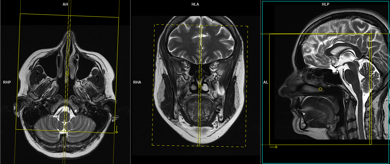 MRI Face (Oral Cavity) Protocols and Planning | Indications for MRI ...
