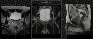 Urinary bladder MRI Protocols and Planning | Indications for MRI ...