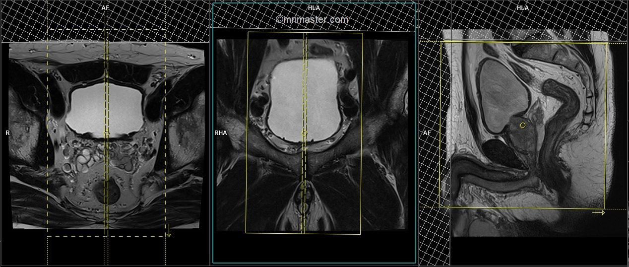 Urinary bladder MRI Protocols and Planning | Indications for MRI ...