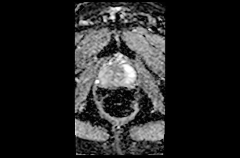 PROSTATE axial ZOOMit images - mrimaster