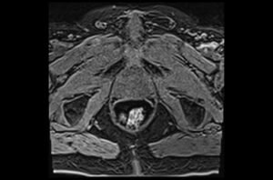 PLAN PROSTATE axi post gad 2 - mrimaster