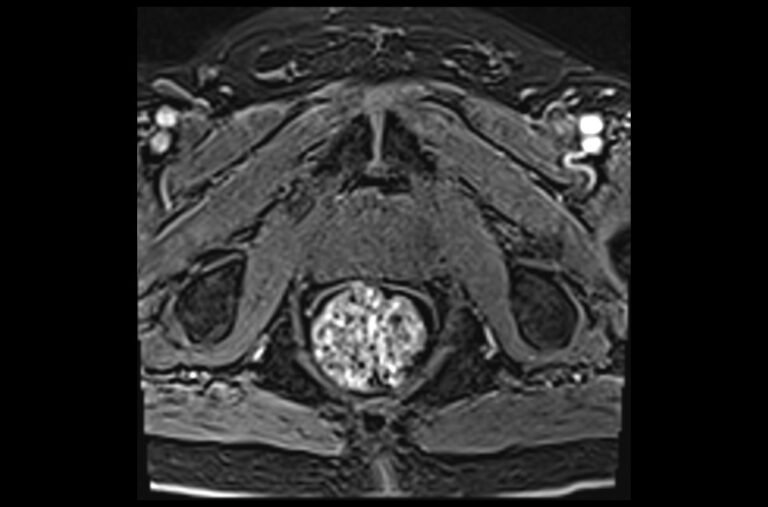 PLAN PROSTATE axi post gad 4 - mrimaster