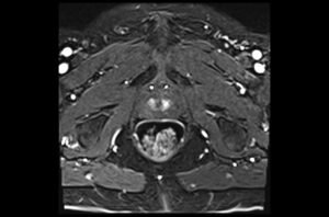 PLAN PROSTATE axi post gad 5 - mrimaster