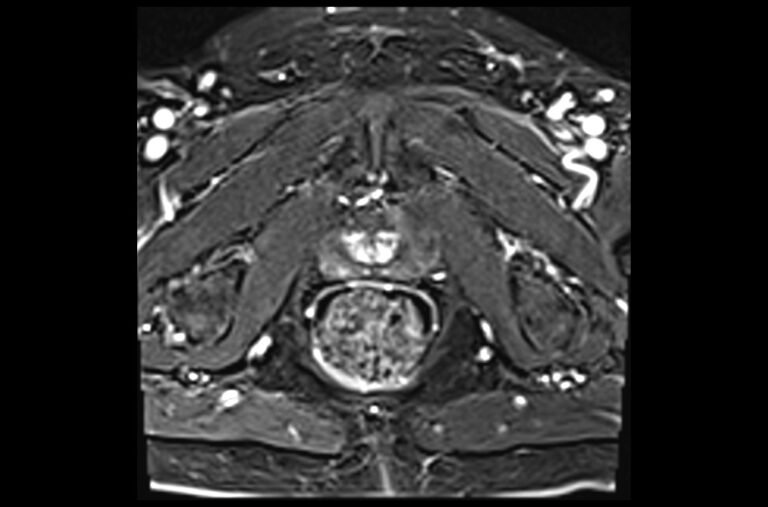 PLAN PROSTATE axi post gad 6 - mrimaster