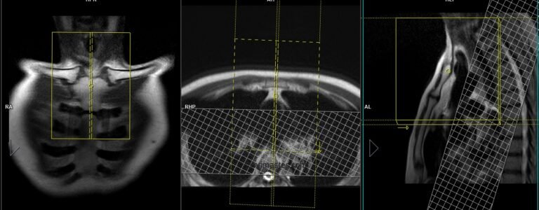 MRI Sternoclavicular Joint Protocol, Planning and Incications