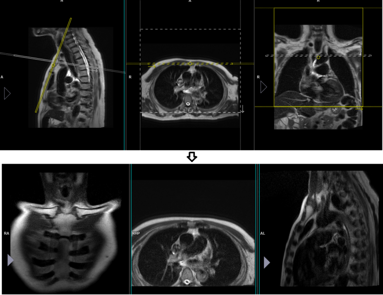 MRI Sternoclavicular Joint Protocol, Planning and Incications