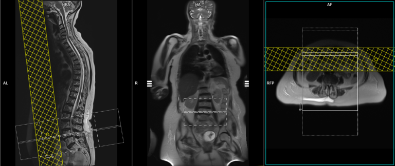 mri full spine | MRI whole spine automatic composing protocol and planning