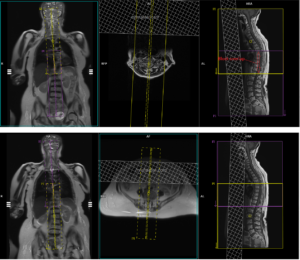 mri full spine | MRI whole spine automatic composing protocol and planning