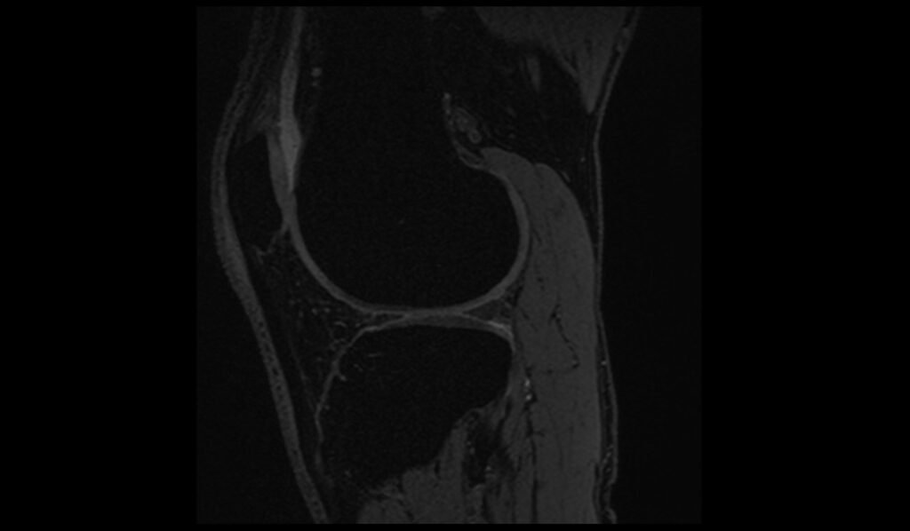 DESS MRI sequence | FADE MRI| double-echo steady-state sequence physics ...