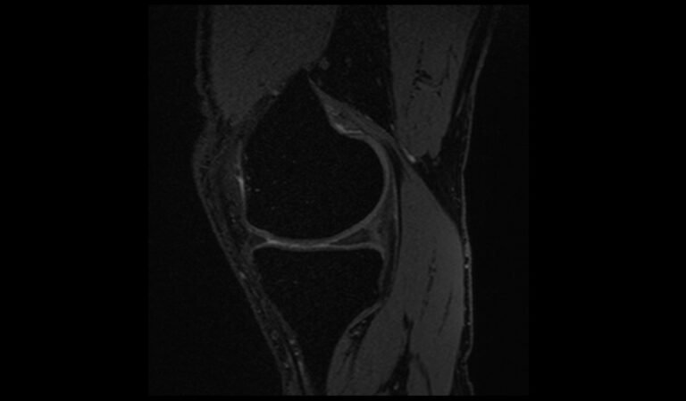 DESS MRI sequence | FADE MRI| double-echo steady-state sequence physics ...