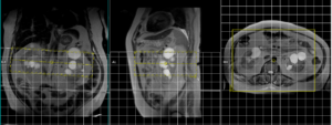 NATIVE MRI | Native Space MRI | NATIVE MRA Protocol and Planning