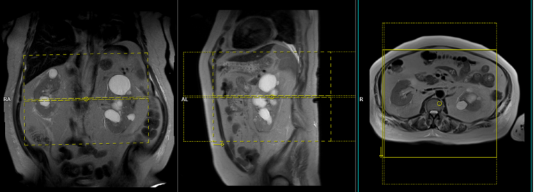 NATIVE MRI | Native Space MRI | NATIVE MRA Protocol and Planning