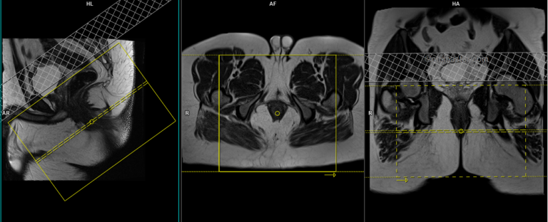 PLAN FISTULA normal variation planning - mrimaster