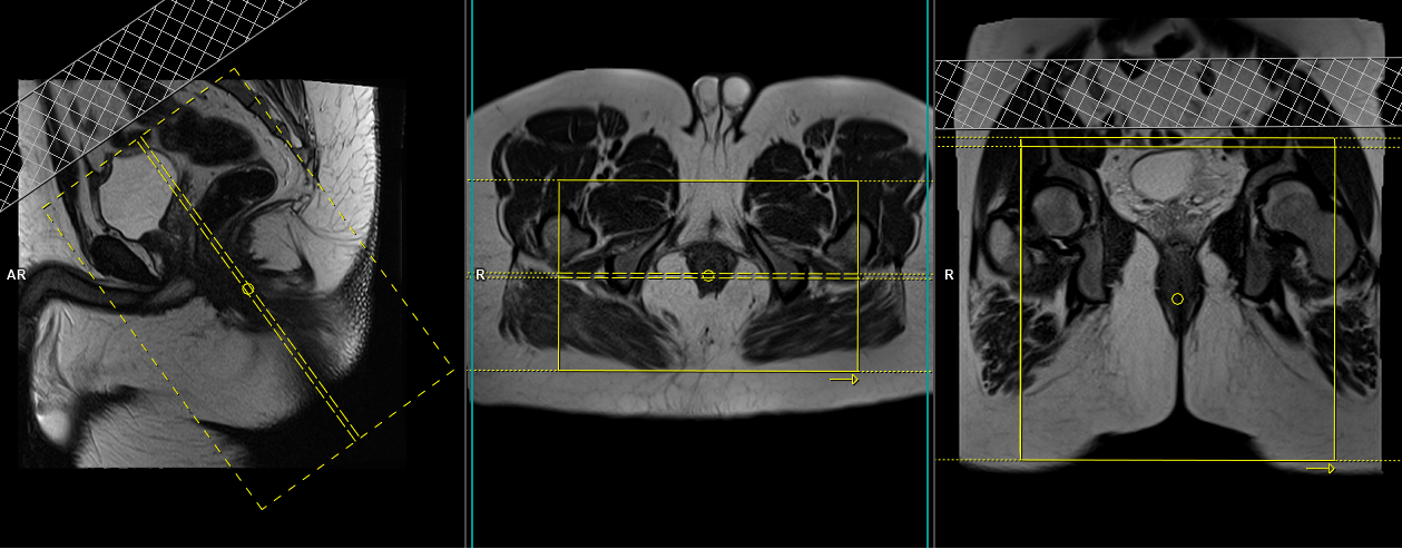 PLAN FISTULA normal variation planning - mrimaster