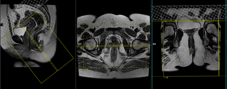 MRI Pelvis Anal fistula protocols and planning | Indications for MRI ...