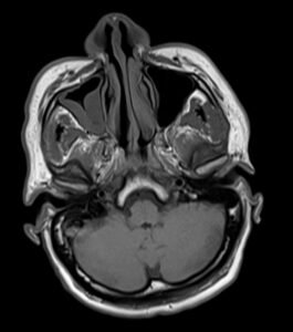 MRI Soft tissue neck axial T1 images