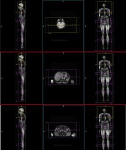 Whole body DWI , Whole body DWI planning and protocol