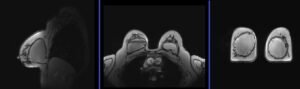 Breast implant MRI Scan Protocols and Planning