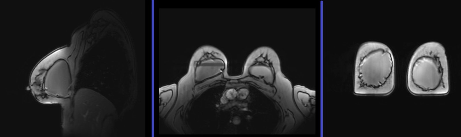 Breast implant MRI Scan Protocols and Planning