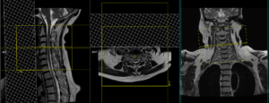 MRI cervical spine exit forearm view