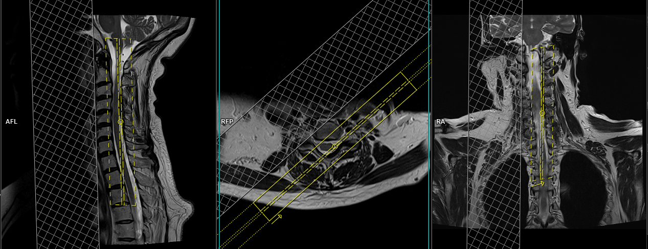 MRI cervical spine exit forearm view