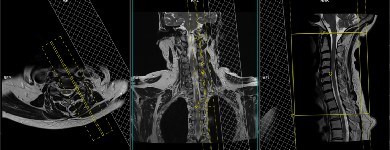 MRI cervical spine exit forearm view